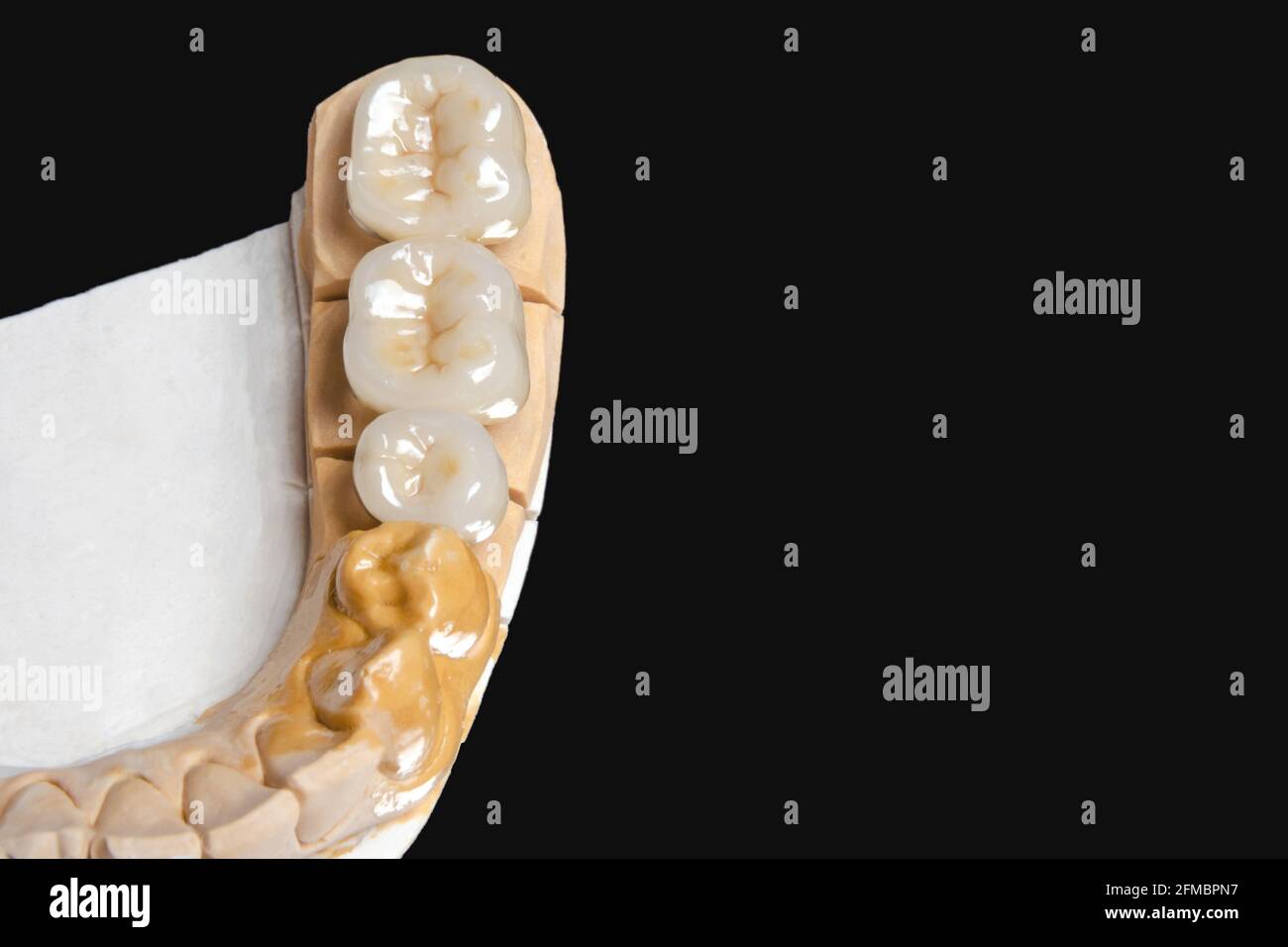 ceramic dental bridge for molars and premolars. on a black background ...