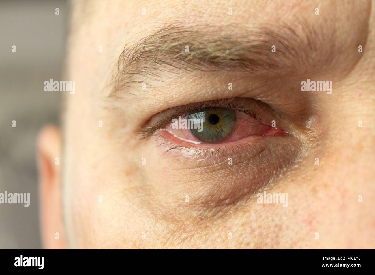 Red and inflamed eye close-up. Patient's red eye. Allergic reaction ...