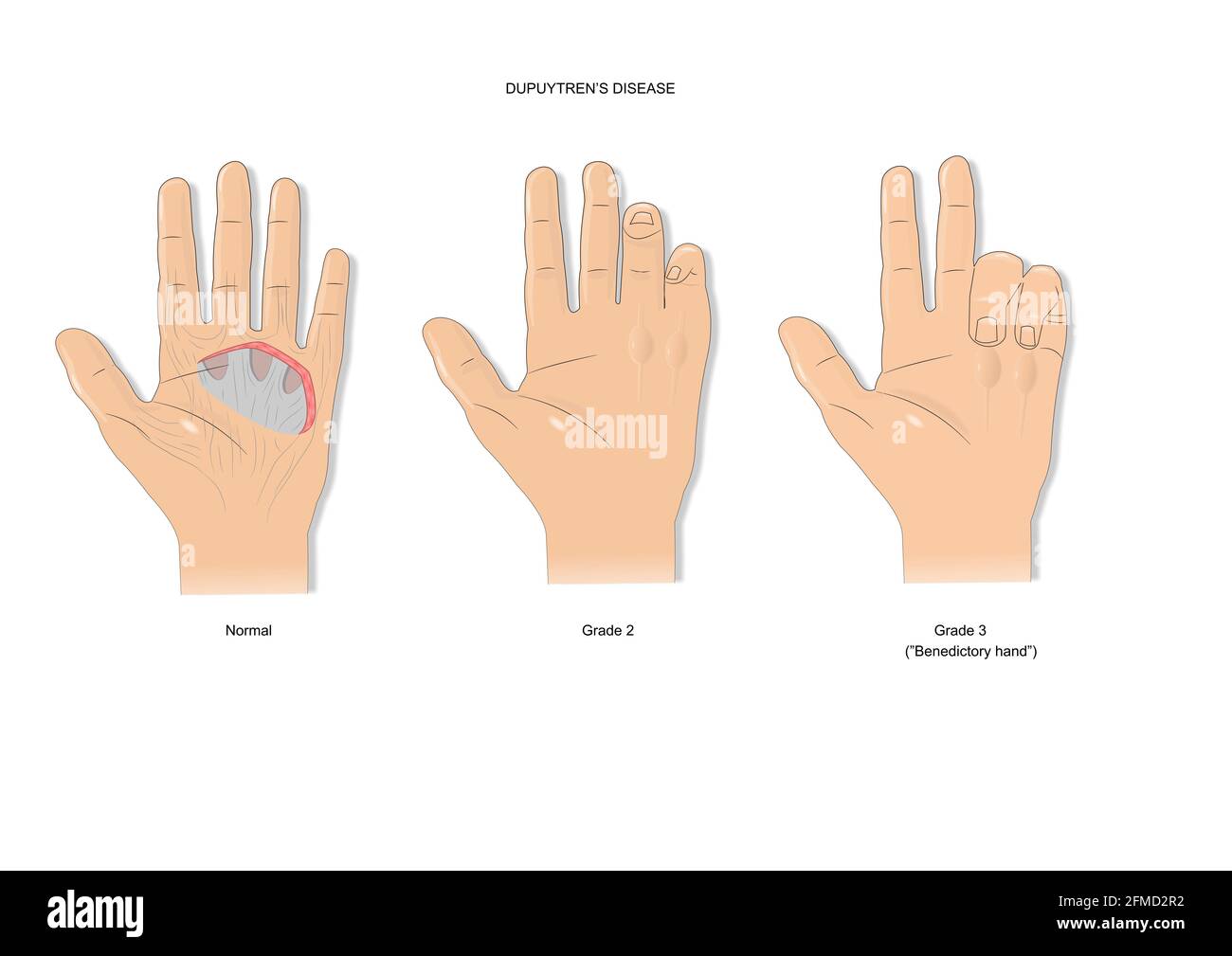 Dupuytrens contracture hand surgery hi-res stock photography and images ...