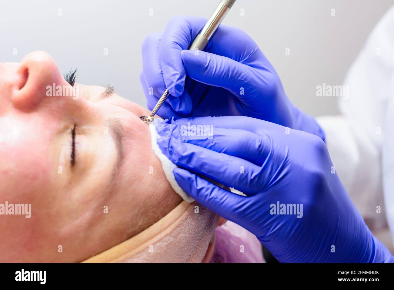 Skin impurities hi-res stock photography and images - Alamy