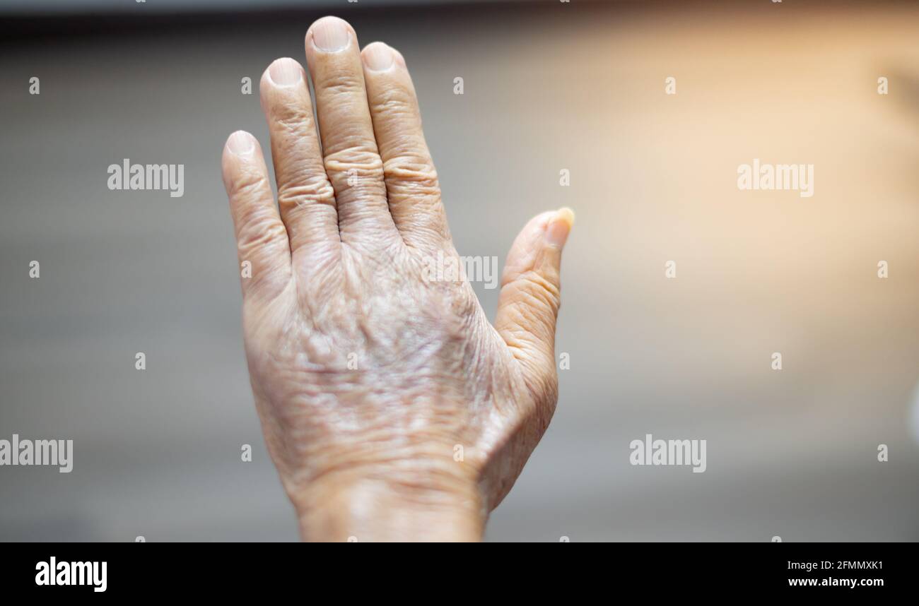 Bruised Arm High Resolution Stock Photography and Images - Alamy