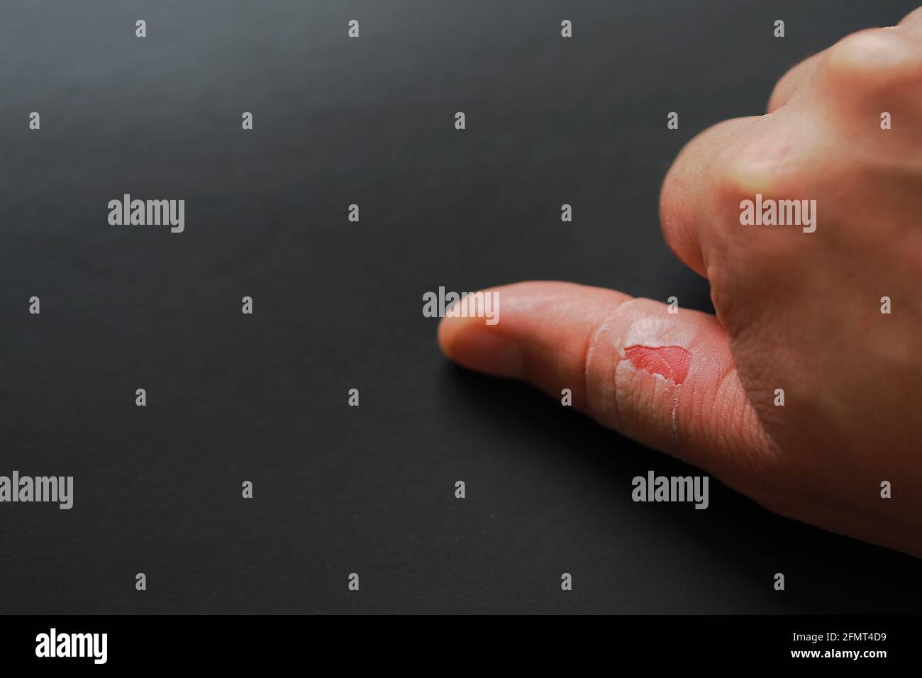 skinning skin between the fingers, the hands of one person injured ...