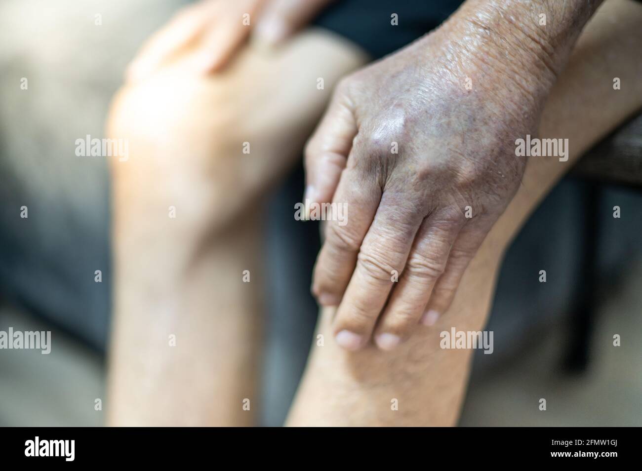 Bruised Hands High Resolution Stock Photography and Images - Alamy