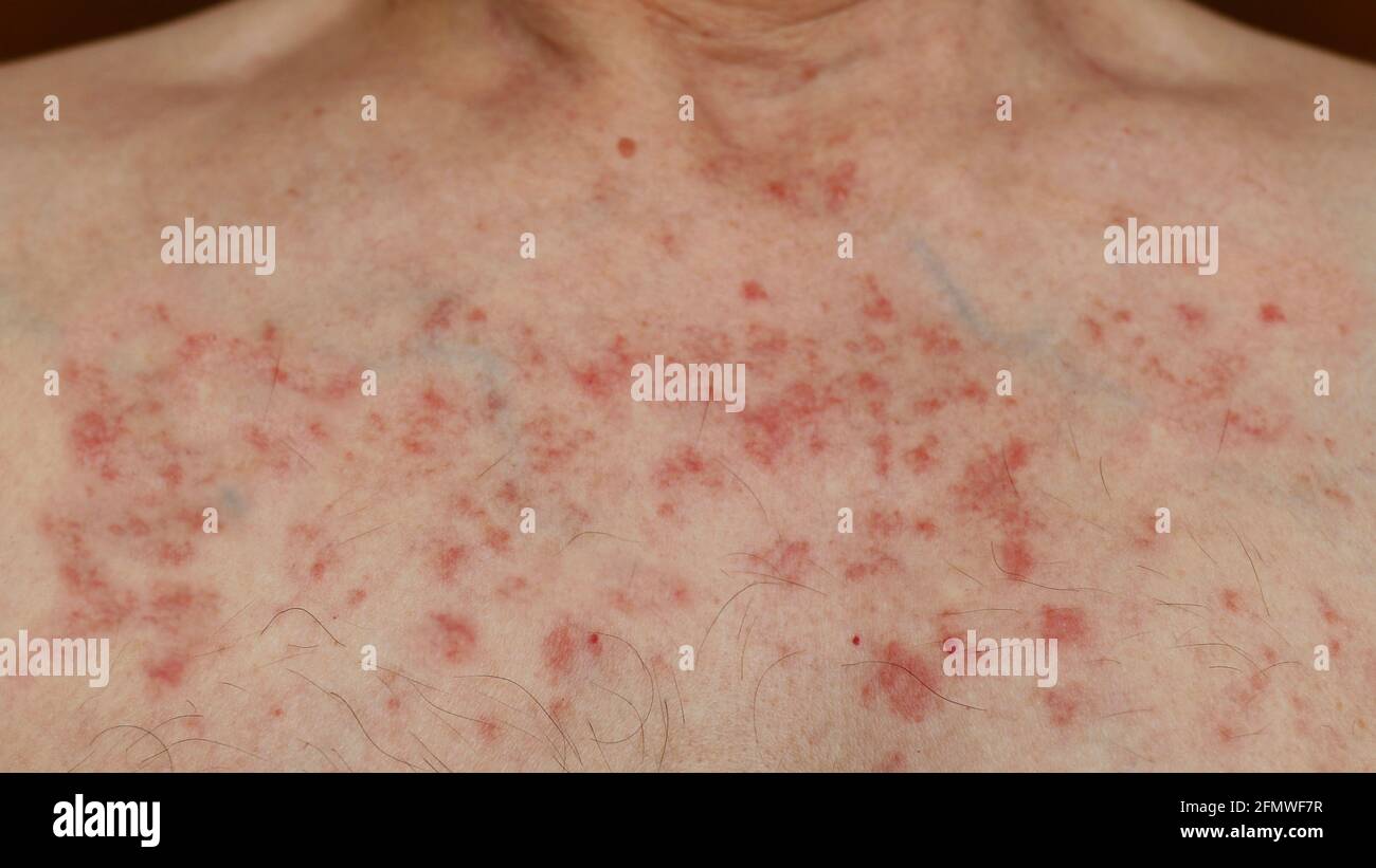 Skin Reaction On A Man Chest After Chemotherapy Allergic Reaction Allergic Rash On Chest Skin