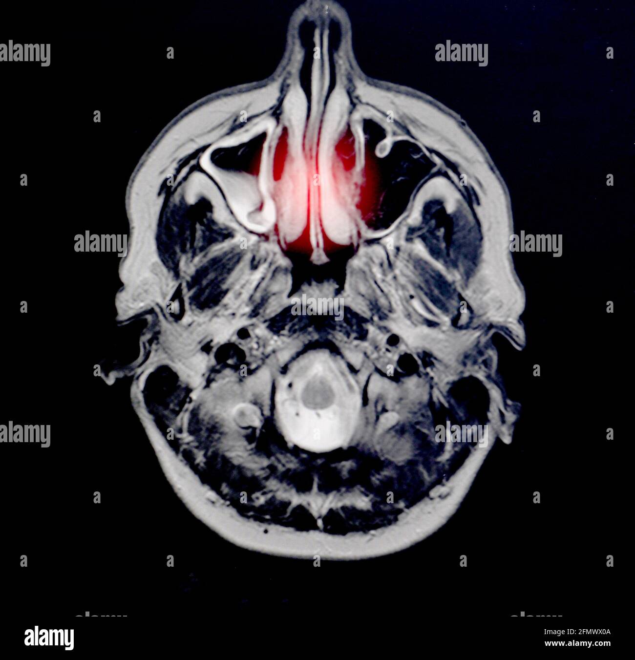Magnetic resonance imaging of a patient with bad nose breathing, nasal ...