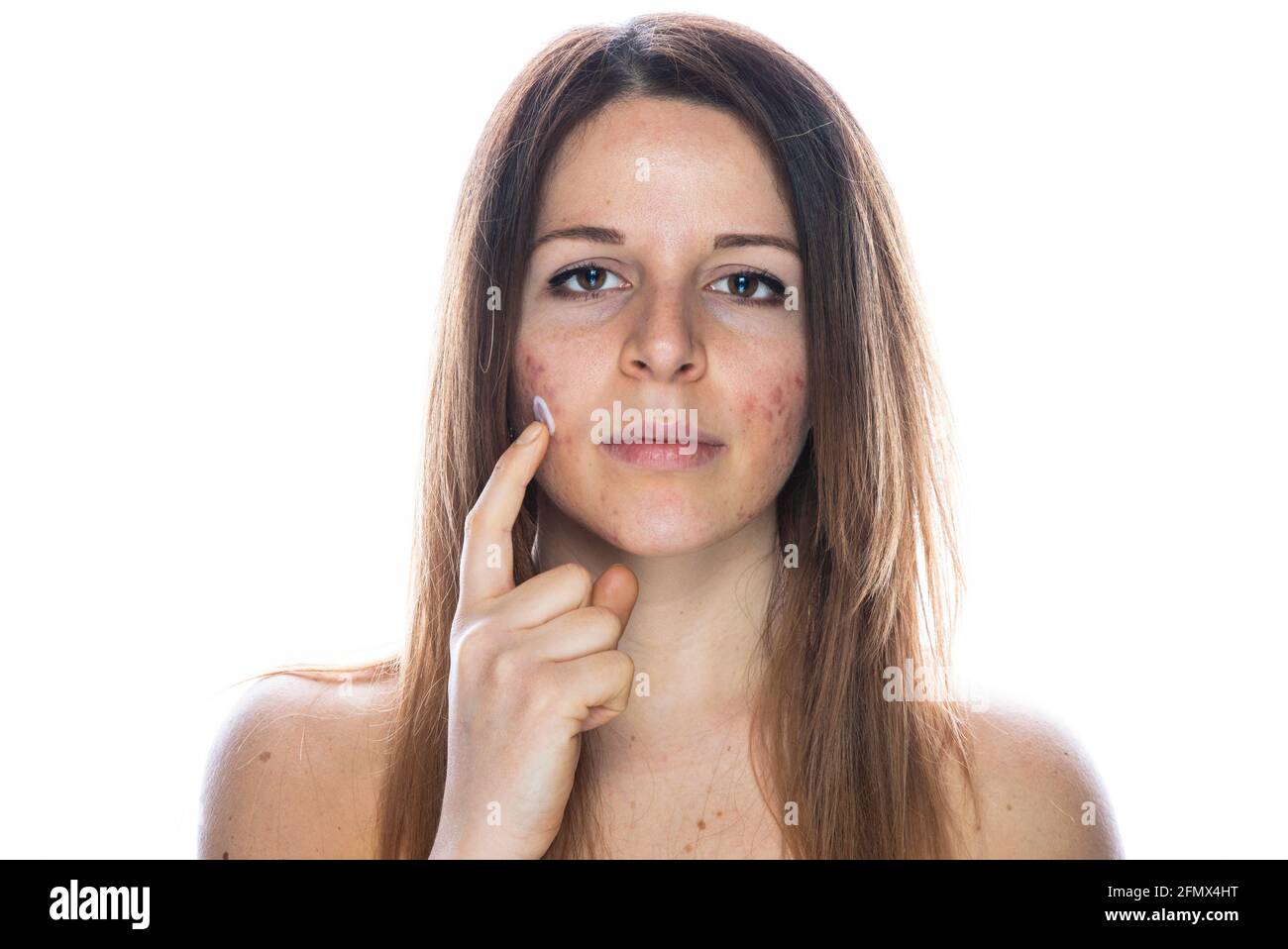 Problem skin hi-res stock photography and images - Alamy
