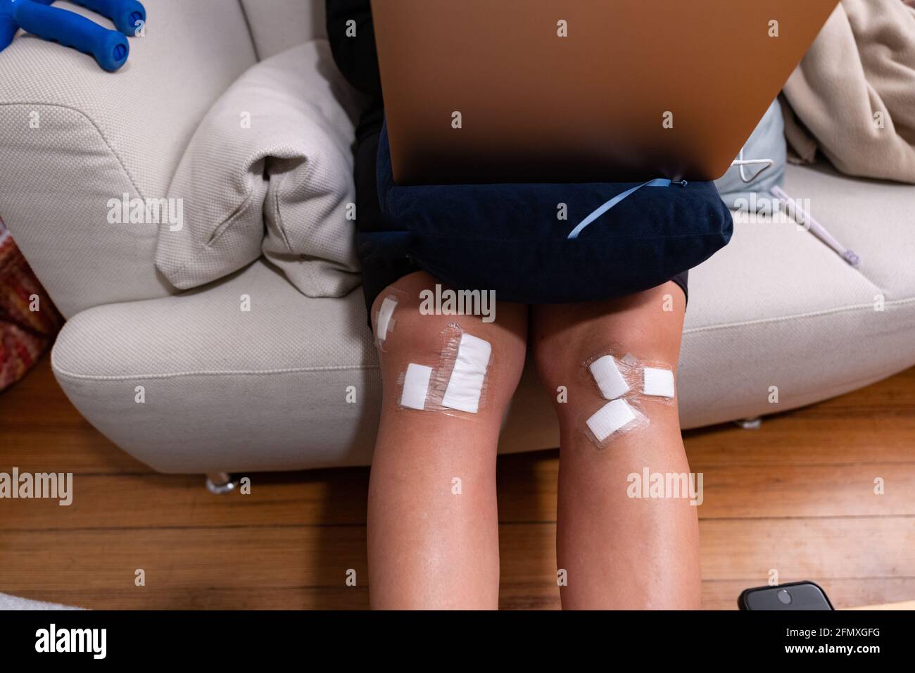 Protective patch on legs of young woman in convalescence. Sitting in ...
