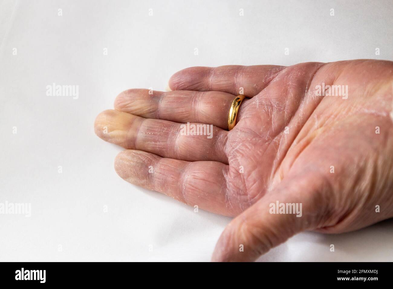 Elderly lady's hand suffering with circulation issues of blue and ...