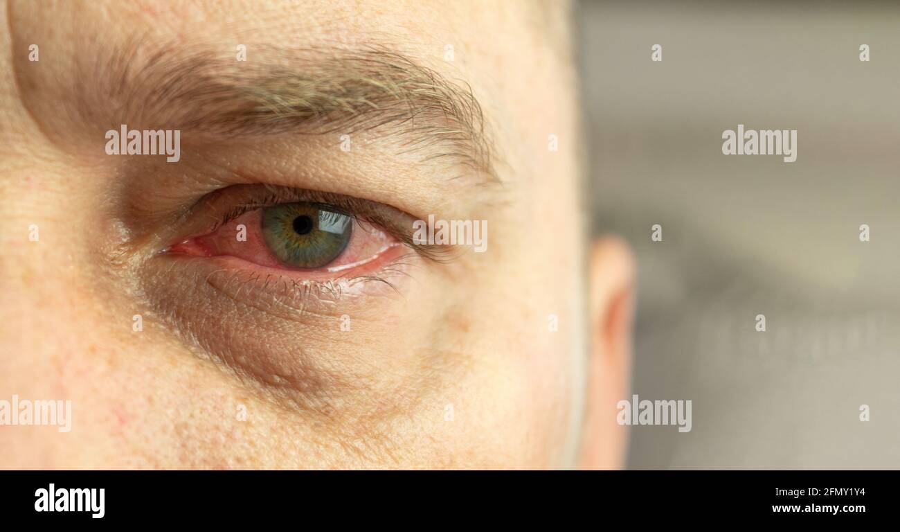 Red and inflamed eye close-up. Patient's red eye. Allergic reaction ...