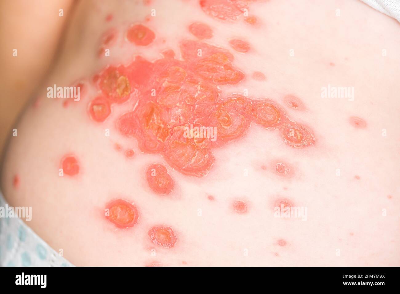 Pityriasis Rosea A Strange Full Body Rash Healdove