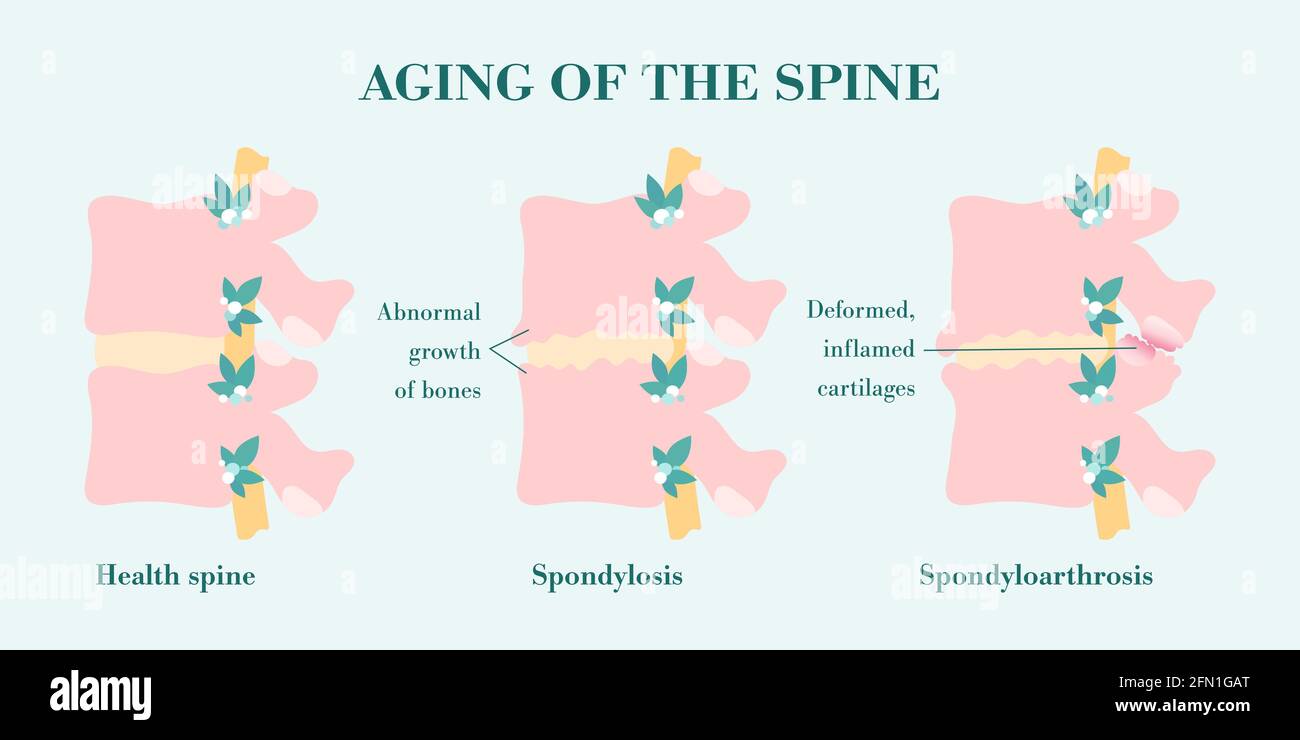 Facet Joint Growth at John Rosado blog