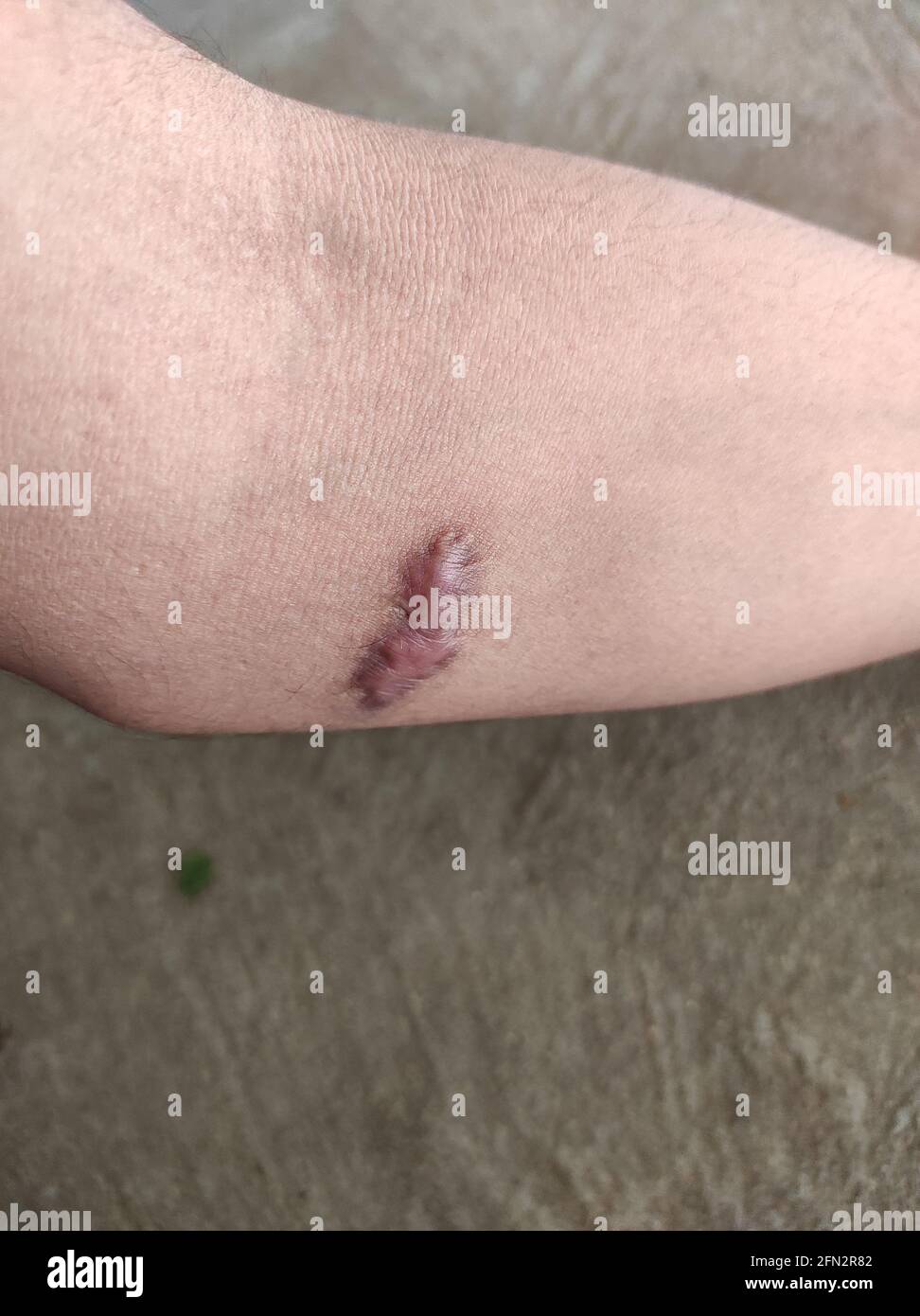 Closeup shot of the keloid scar on a male arm Stock Photo - Alamy