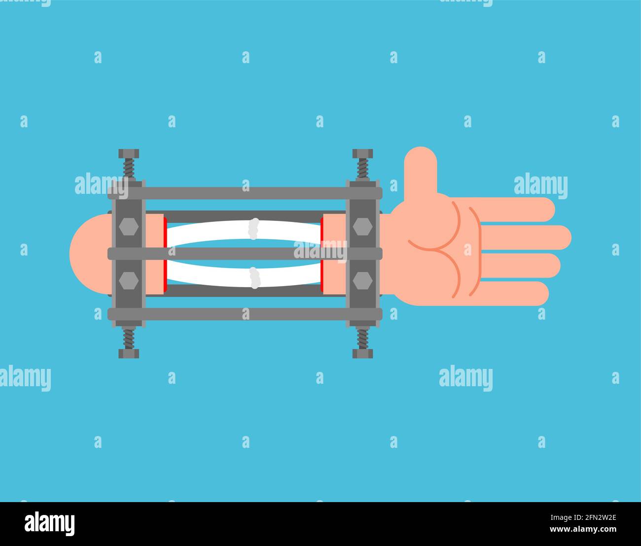 Ilizarov apparatus for arm. Compression-distraction apparatus. Bone ...