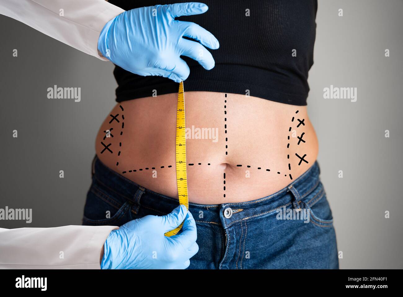 Loose Waist Care By Doctor In Clinic. Liposuction Surgery Stock Photo ...