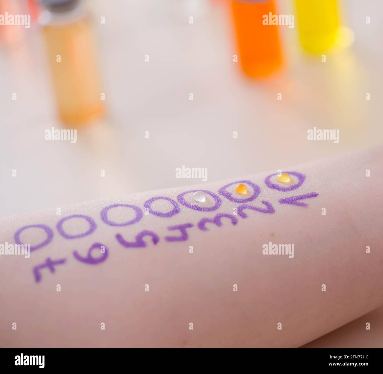 The doctor testing allergy reaction of patient in hospital Stock Photo ...