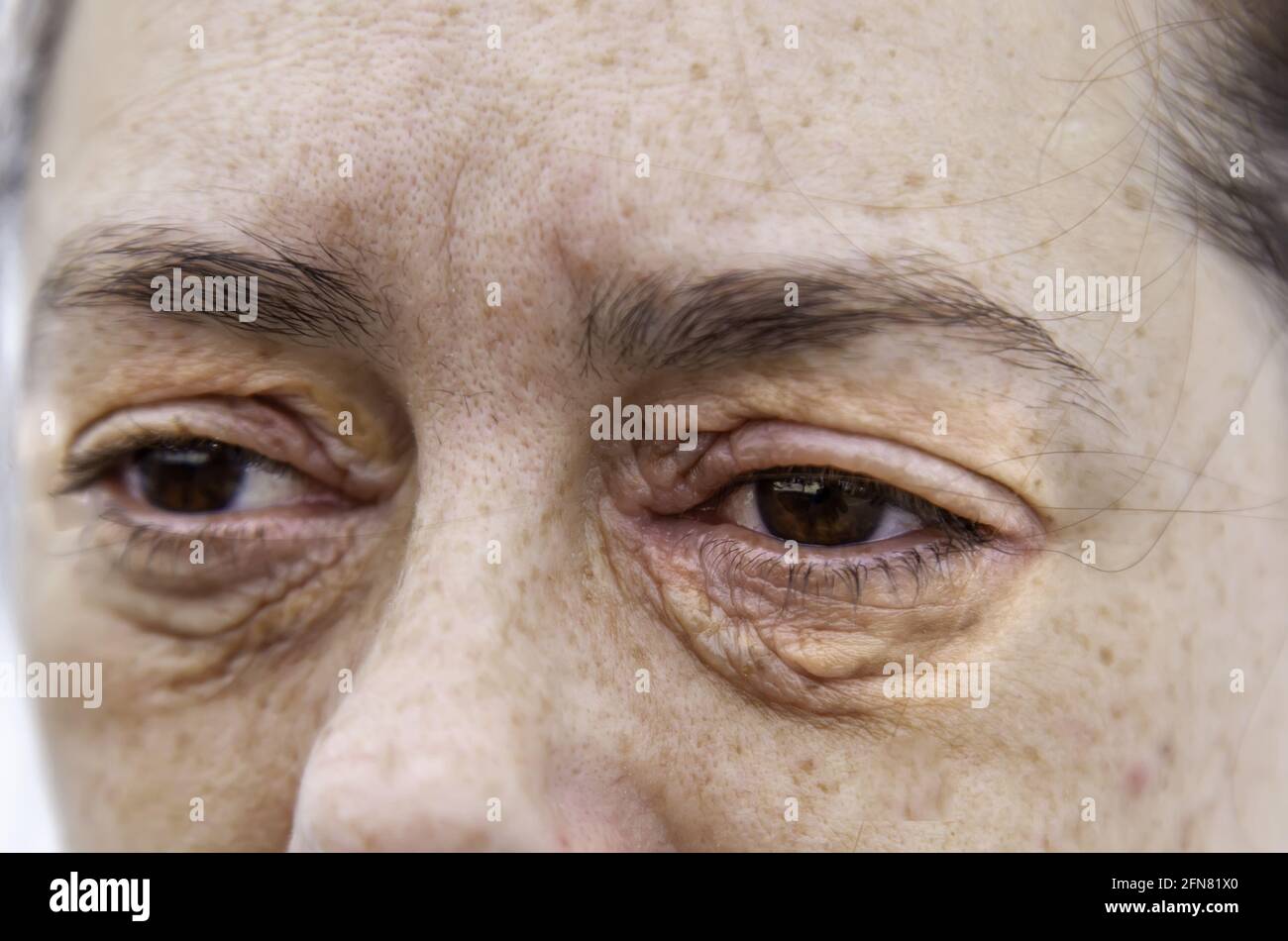 Dermatitis and allergy in eyes, dermatological disease and skin ...