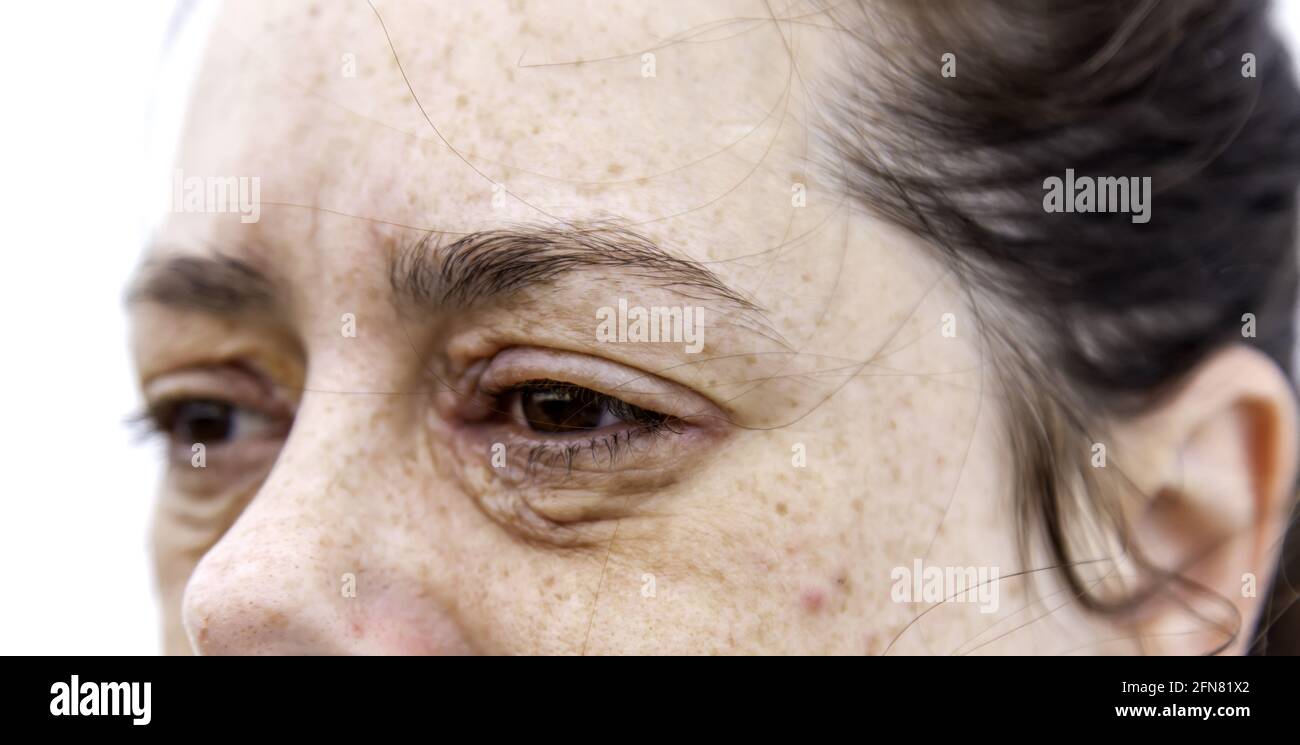 Dermatitis and allergy in eyes, dermatological disease and skin ...