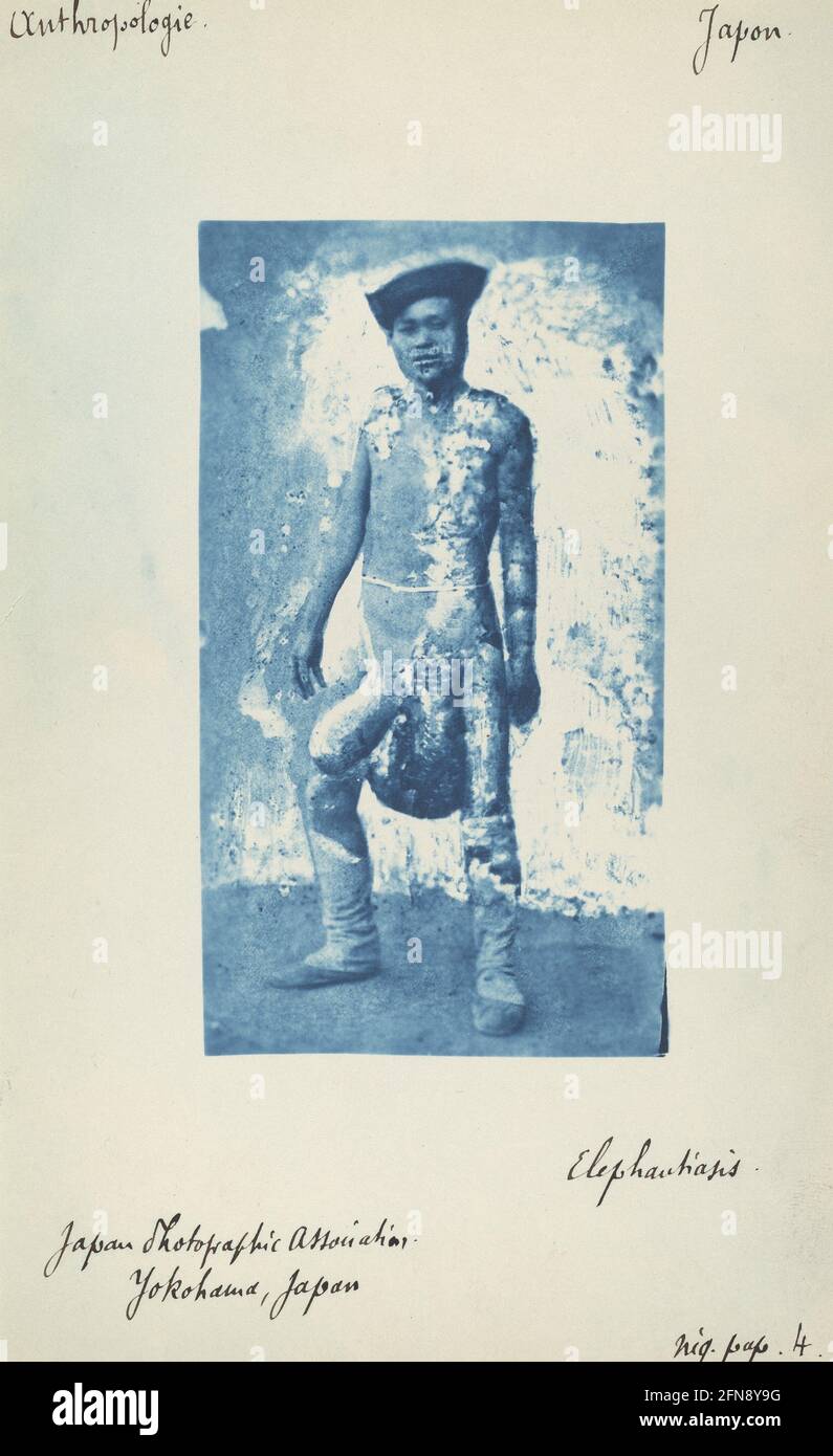 Man with elephantiasis hi-res stock photography and images - Alamy