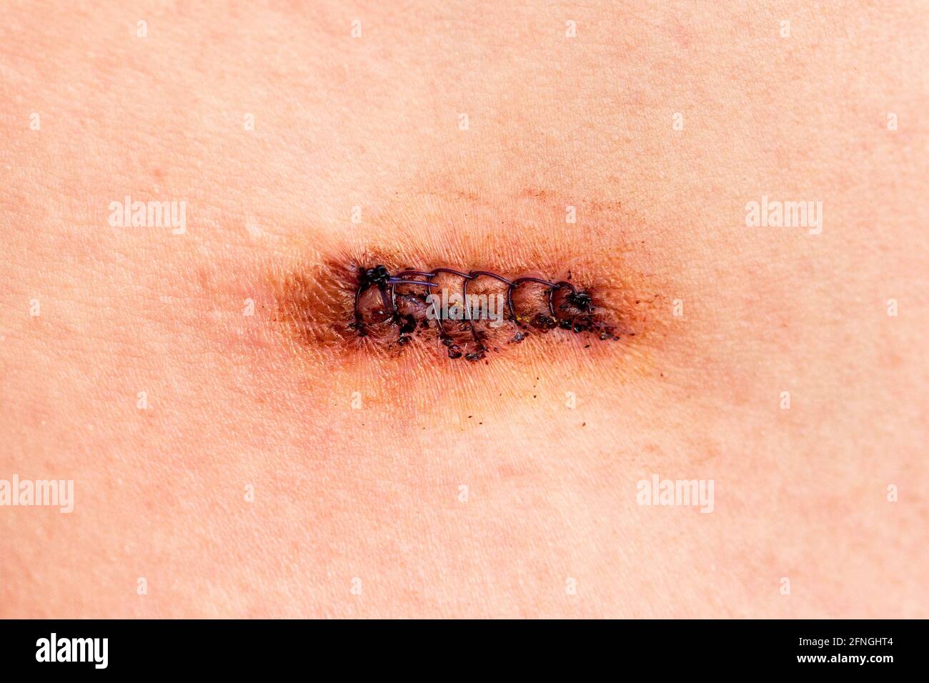 Wound edges hi-res stock photography and images - Alamy