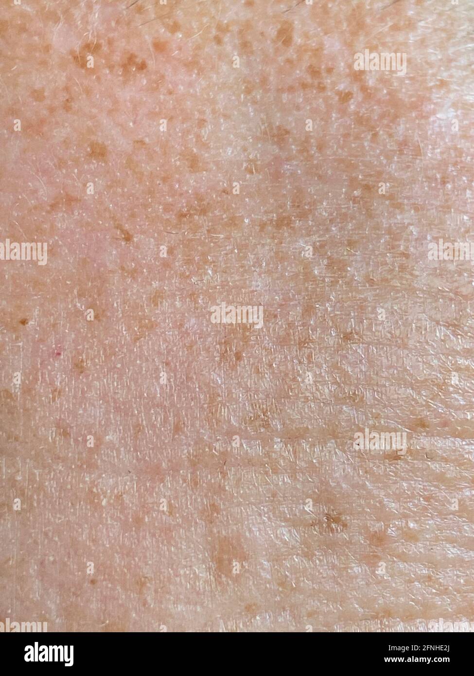 melasma lentigo on the skin of a man macro photo. Skin pigmentation ...