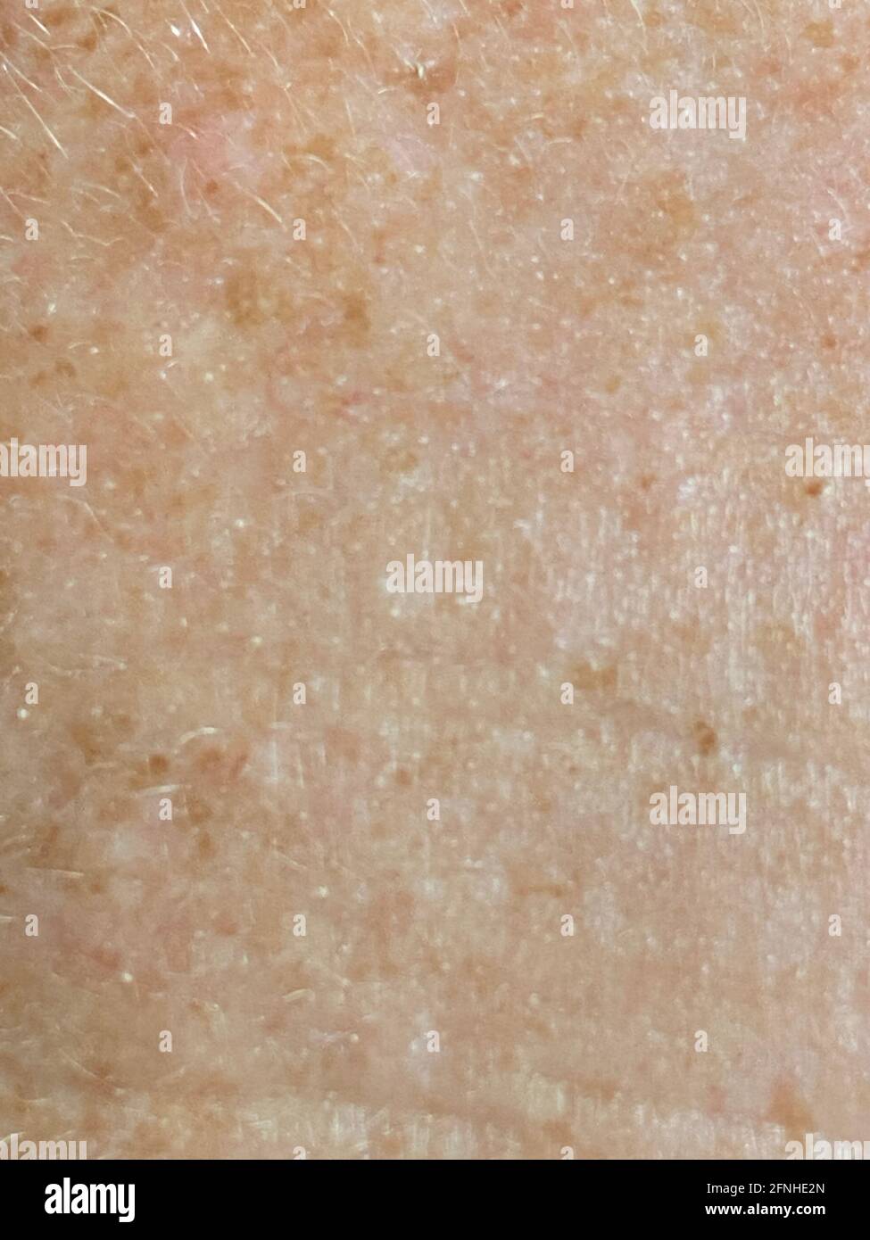 melasma lentigo on the skin of a man macro photo. Skin pigmentation ...