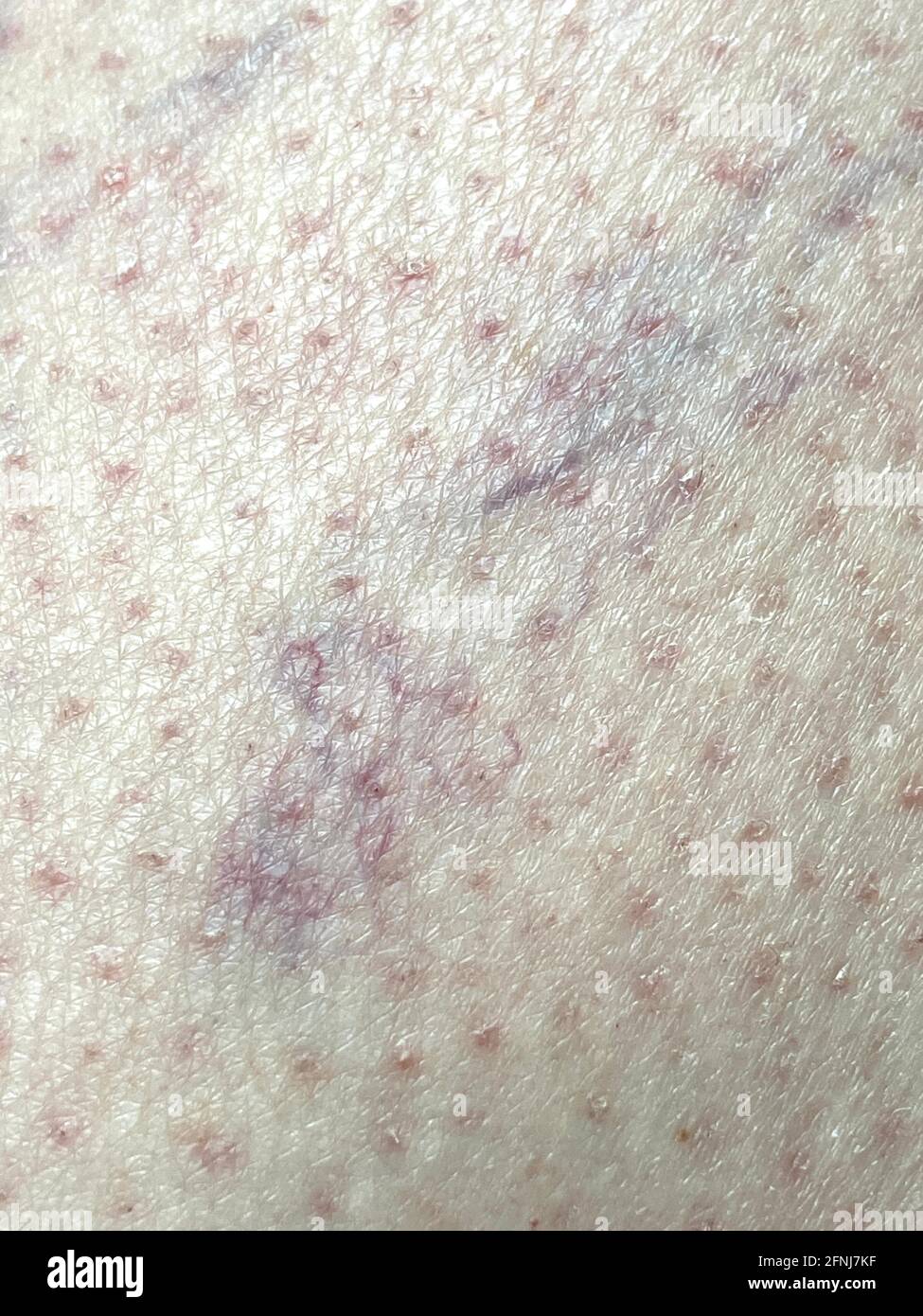 closeup of broken spider vein veins at surface of skin broken veins ...