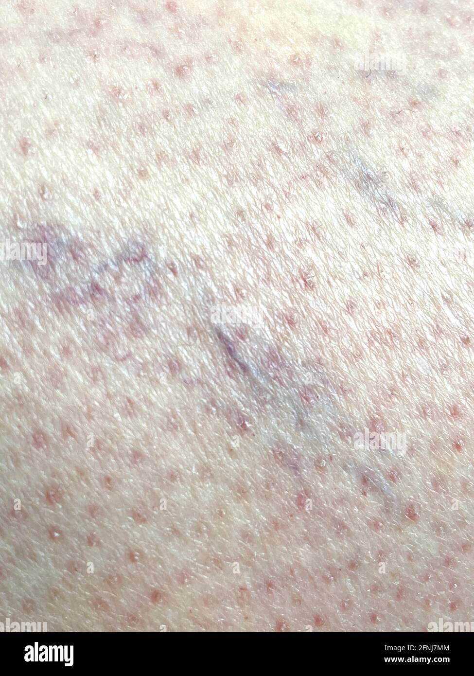 closeup of broken spider vein veins at surface of skin broken veins ...