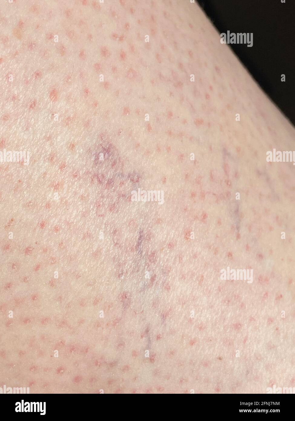 closeup of broken spider vein veins at surface of skin broken veins ...