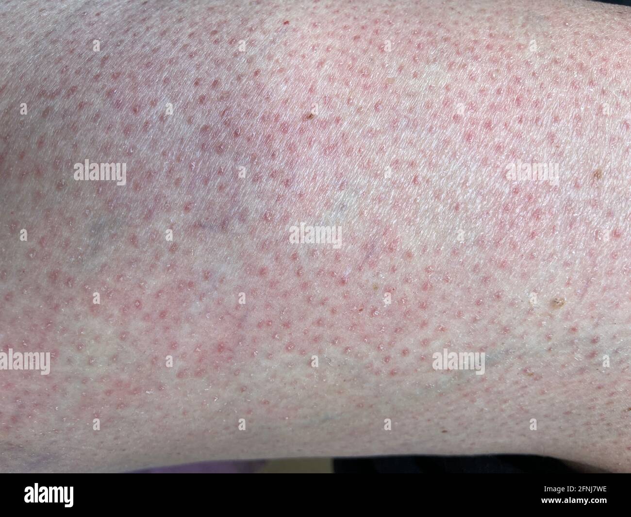 Erythema hi-res stock photography and images - Alamy