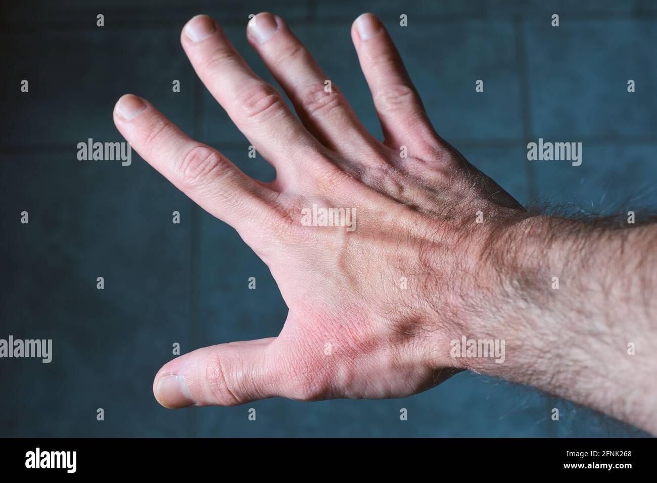 Top view of extended male hand suffering dryness with cracked, wounded ...
