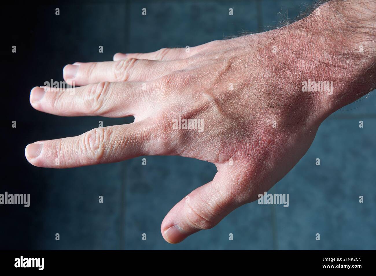 Genetic disorder and painful human condition hi-res stock photography ...