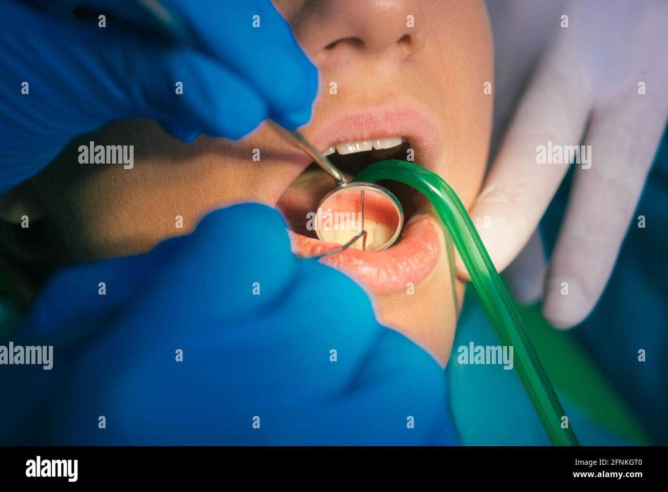 Closeup clean dental examination on a woman's teeth in a dental office ...