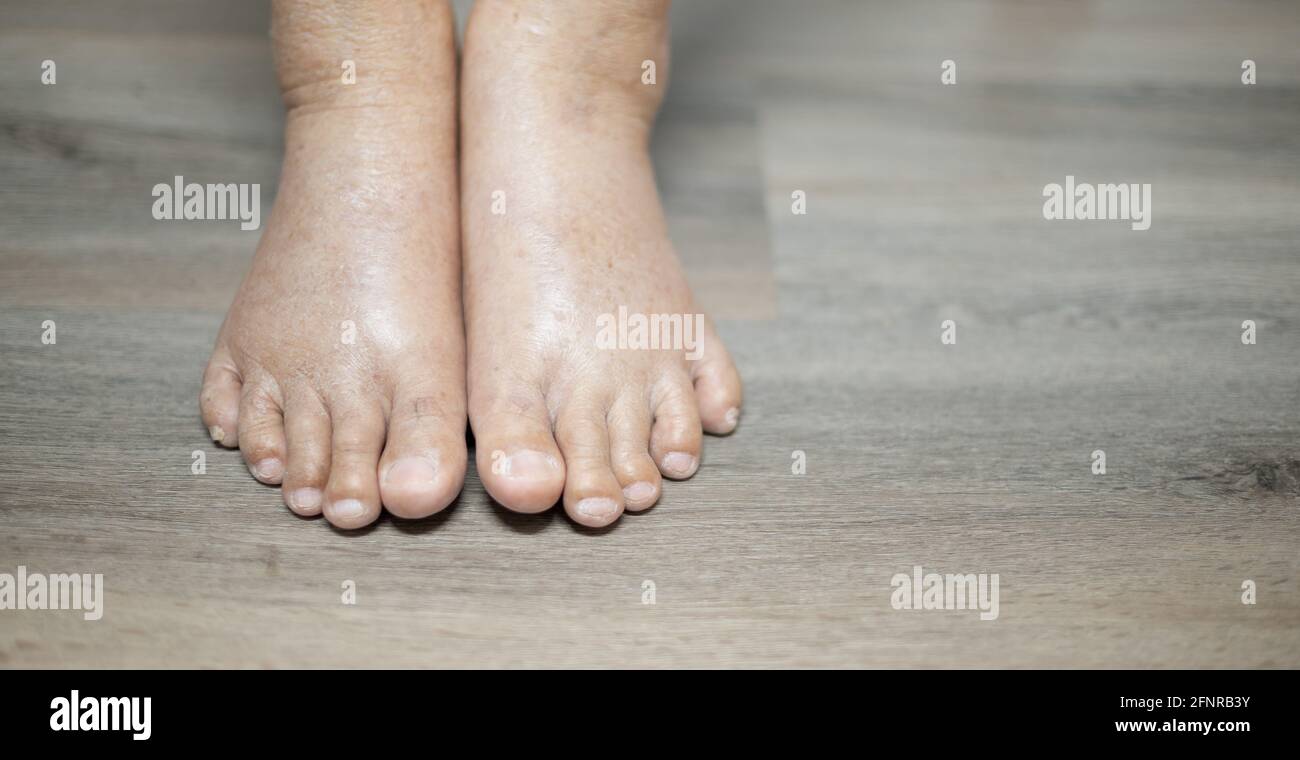 The feet of old man wrinkle skin swollen feet with the cancer and the ...