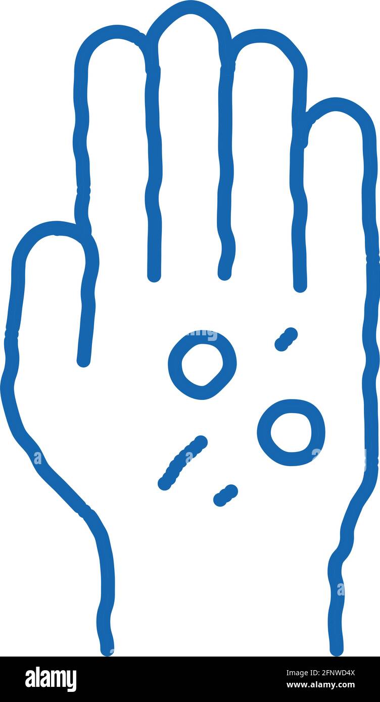 dermatitis rash on hands doodle icon hand drawn illustration Stock ...