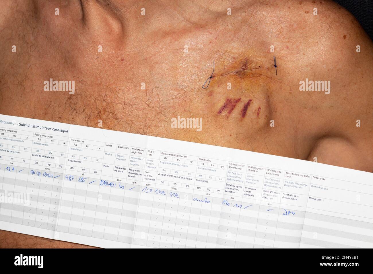 Artificial cardiac pacemaker hi-res stock photography and images - Alamy