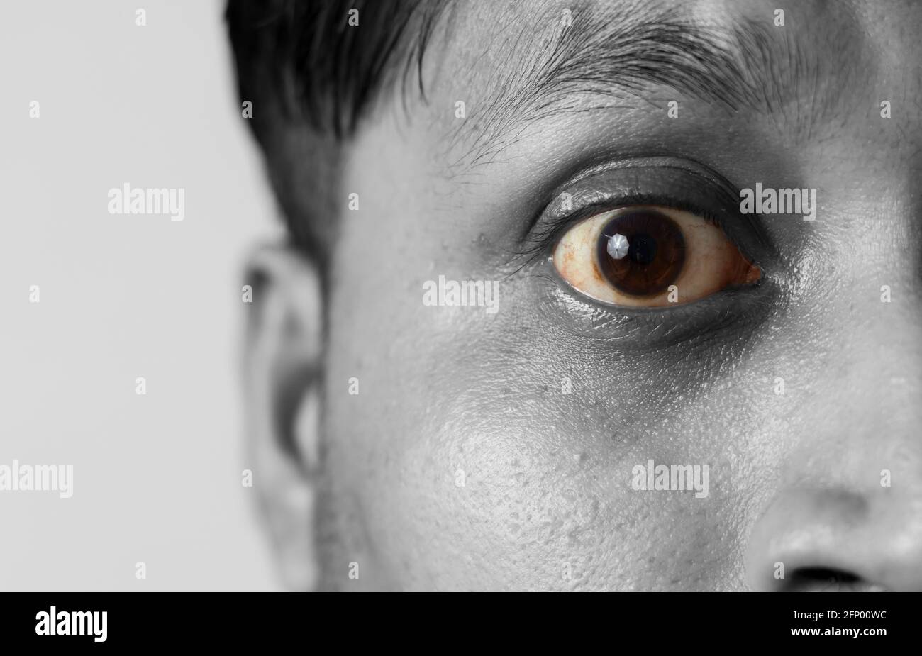 Eye jaundice hi-res stock photography and images - Alamy