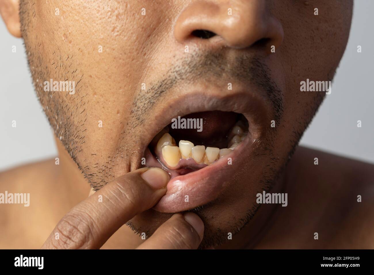 Close-up of irregular teeth shown by an Indian man Stock Photo - Alamy