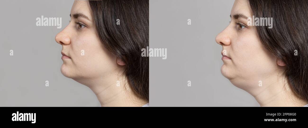 The woman has a double chin. Chin reshaping, fat removal, lifting ...