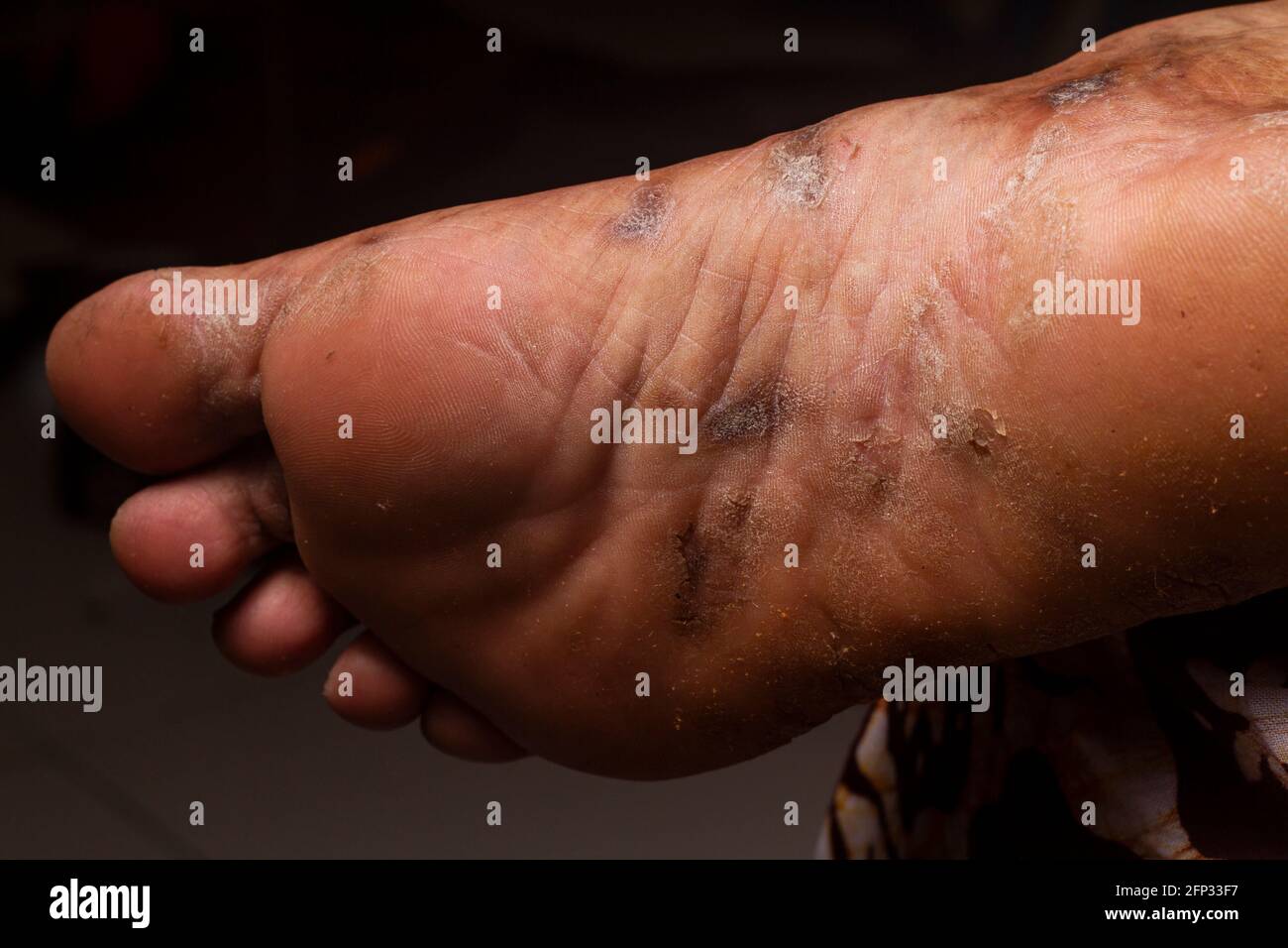 Rash eczema on sole hi-res stock photography and images - Alamy