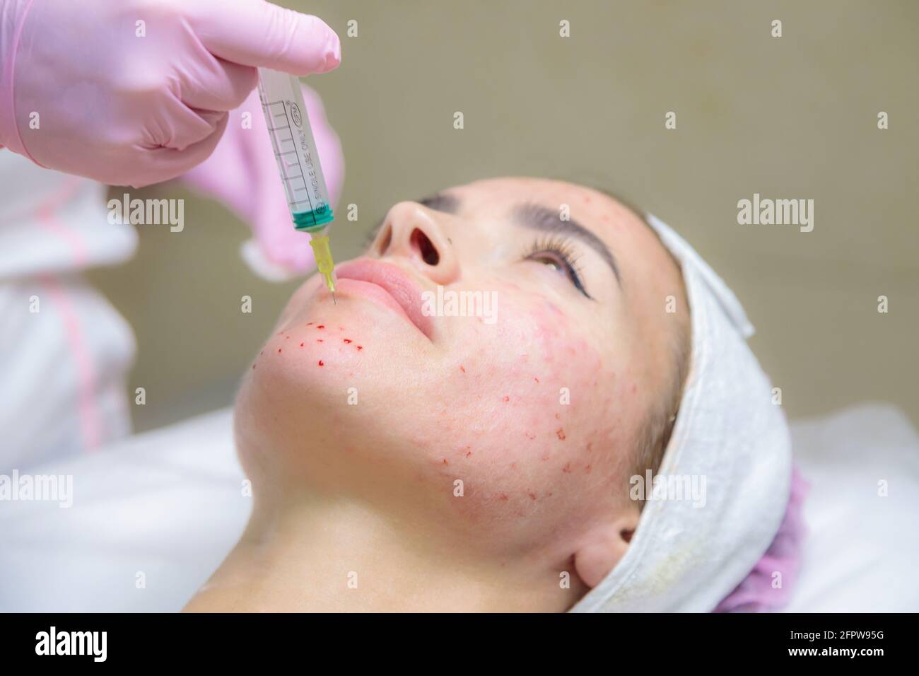 The doctor gives injections of blood plasma into the face of a young ...