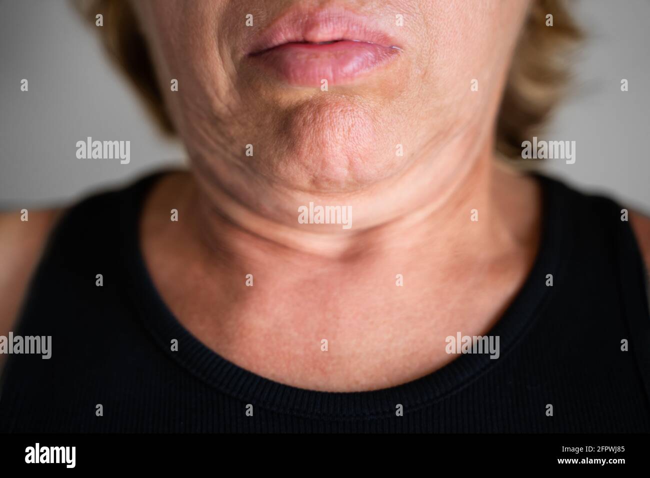 Face With Double Chin And Excess Fat Stock Photo - Alamy