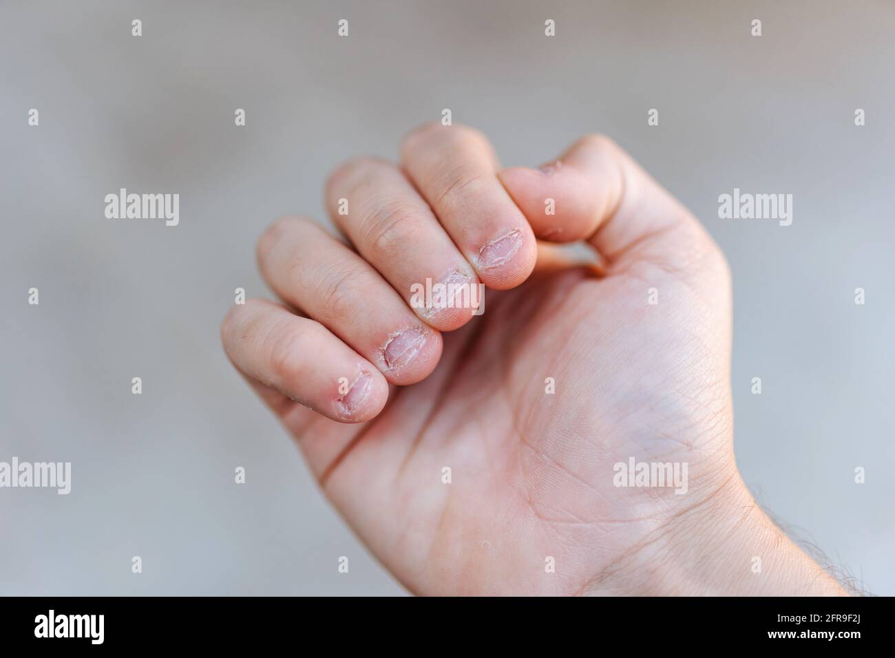 Bitten finger nails hi-res stock photography and images - Alamy