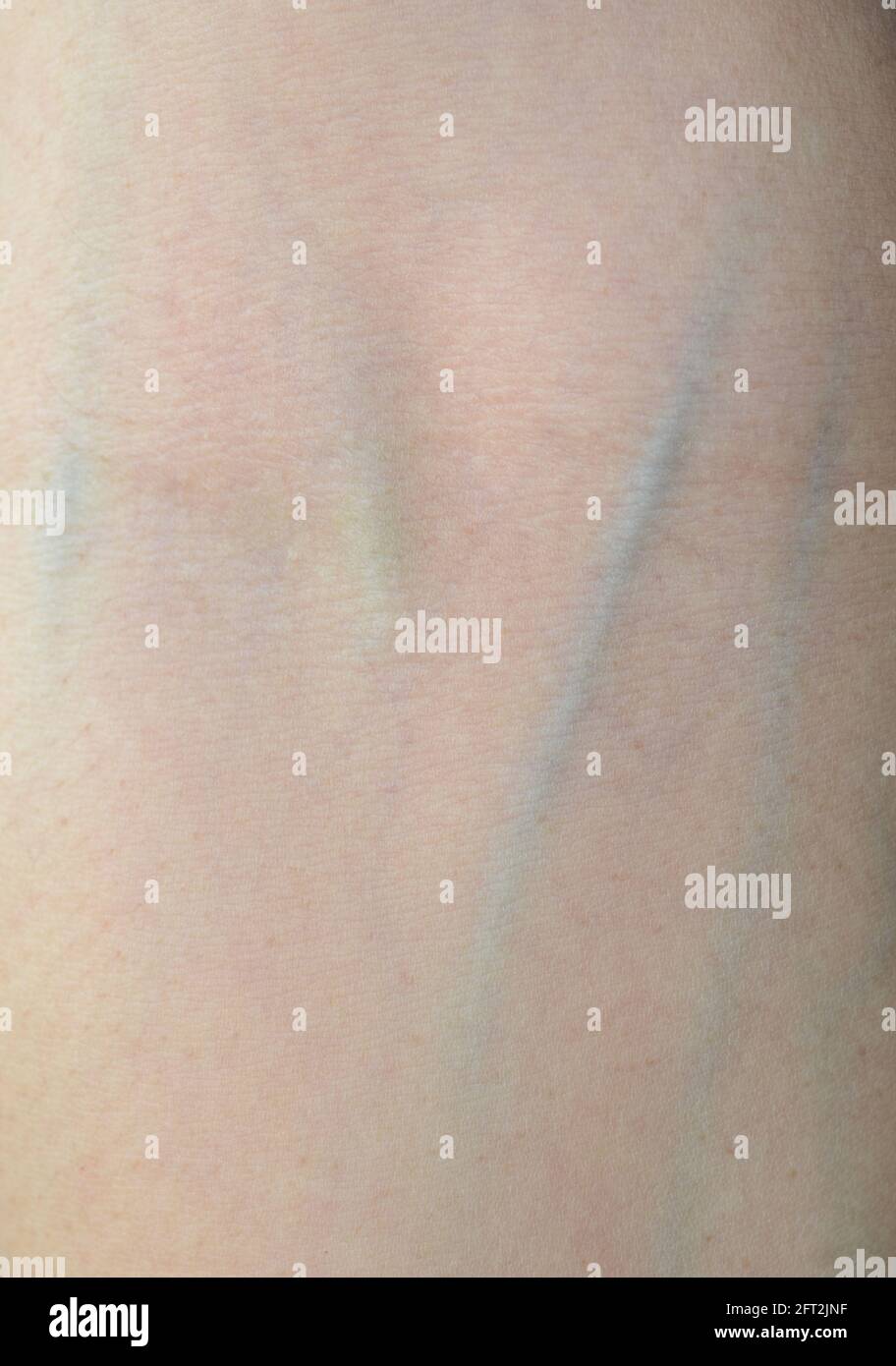 Arm veins hi-res stock photography and images - Alamy
