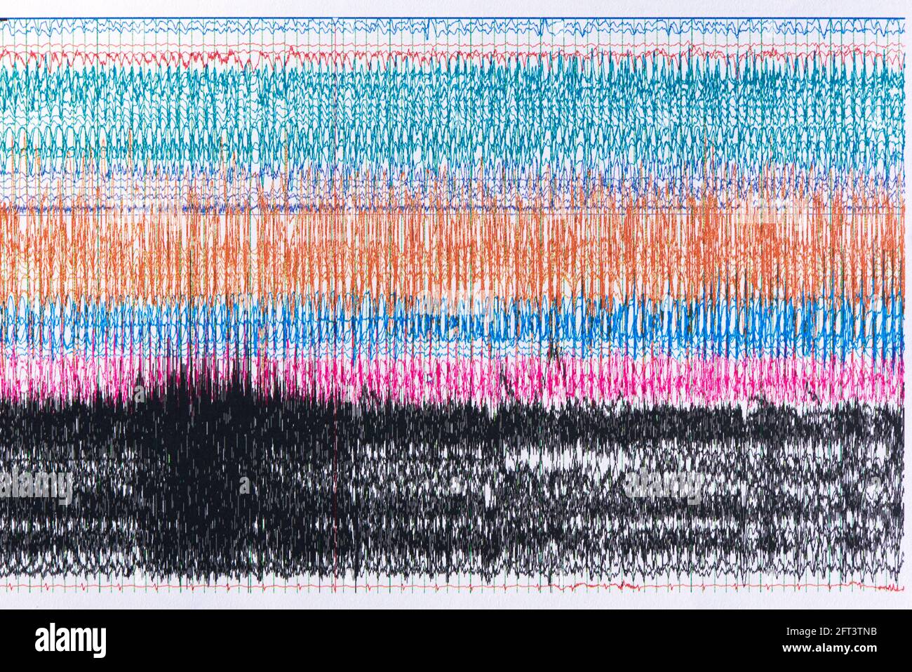 Photograph of brain waves during seizure.or ictal EEG Seizure waves ... Photograph of brain waves during seizure.or ictal EEG Seizure waves ...