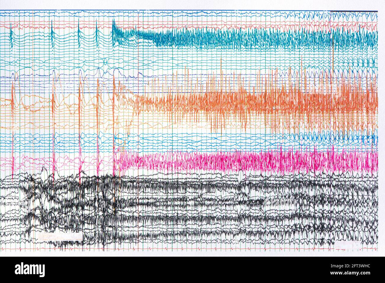 Photograph of ictal EEG recording during seizure. Seizure waves showing ... Photograph of ictal EEG recording during seizure. Seizure waves showing ...