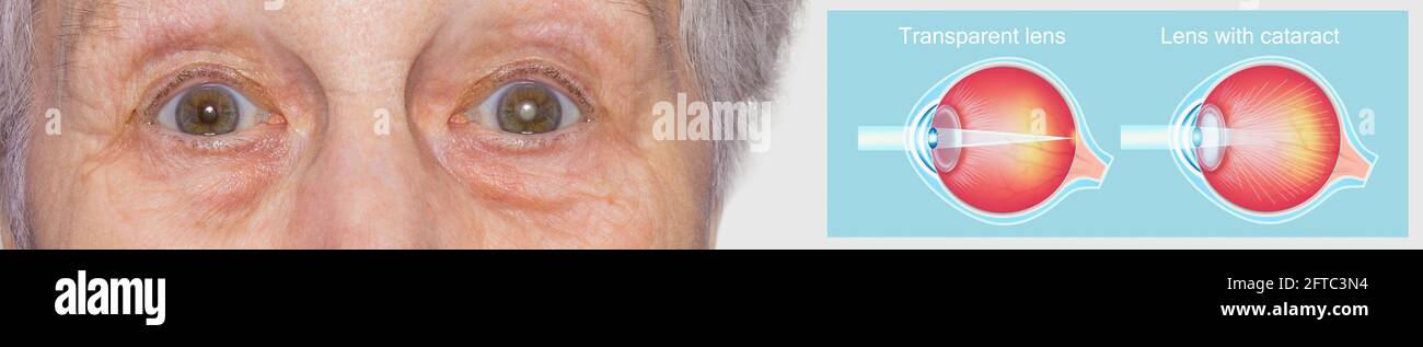 Cataract concept. Senior woman's eye, closeup and cataracts and healthy ...