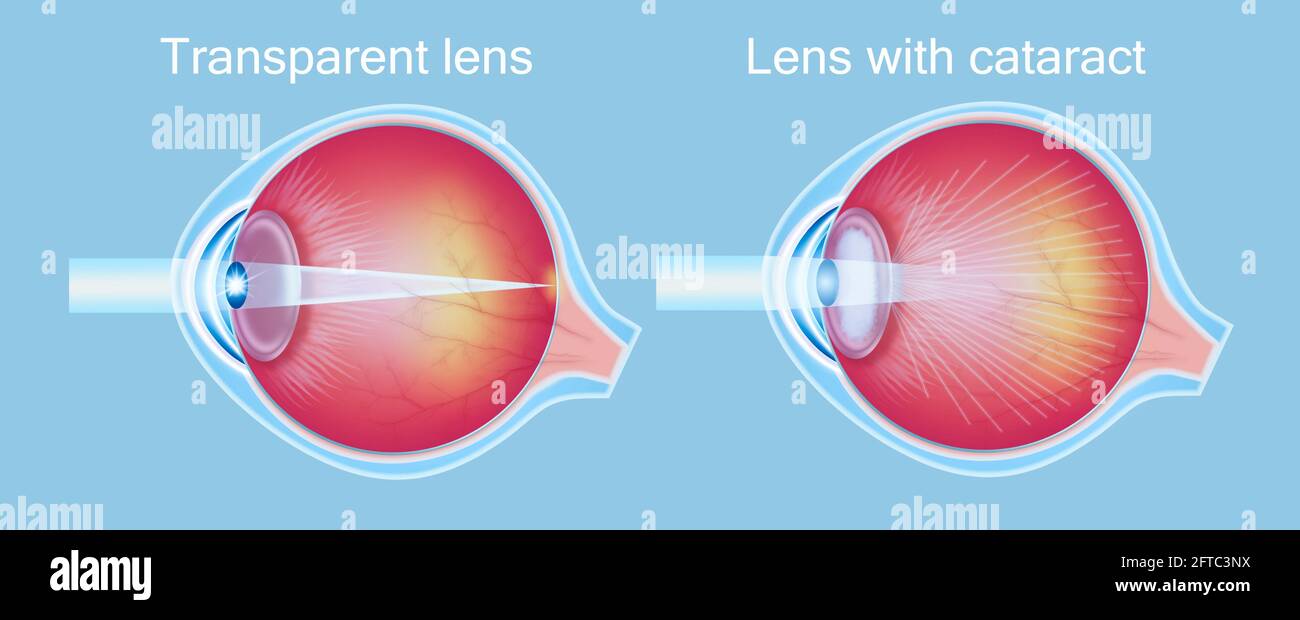 Cataract Eyes. Cataracts and healthy eye detailed structure Stock Photo ...