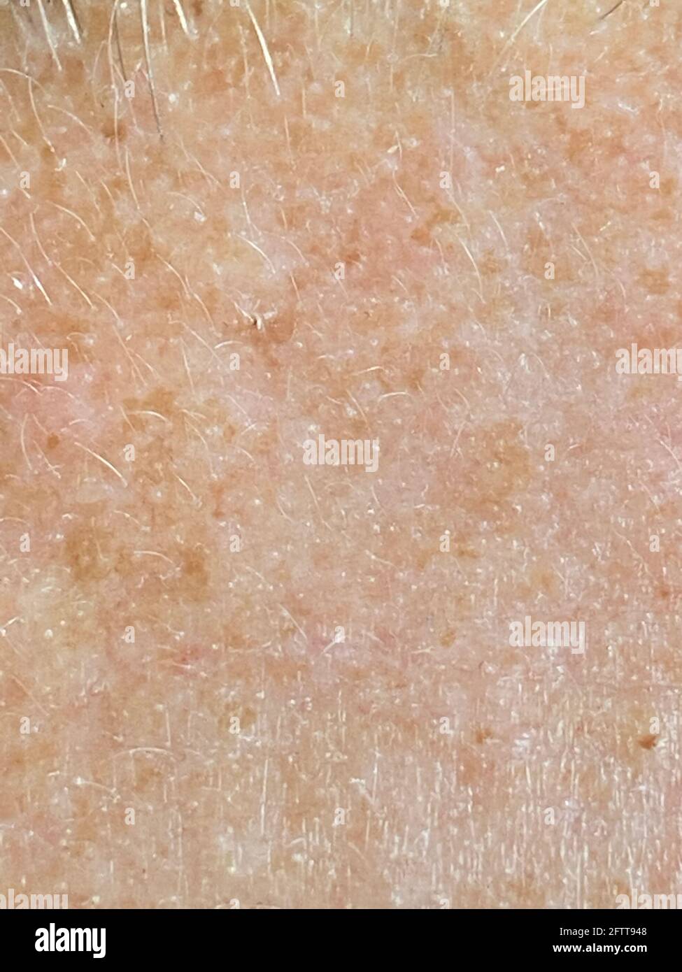 melasma lentigo on the skin of a man macro photo. Skin pigmentation ...