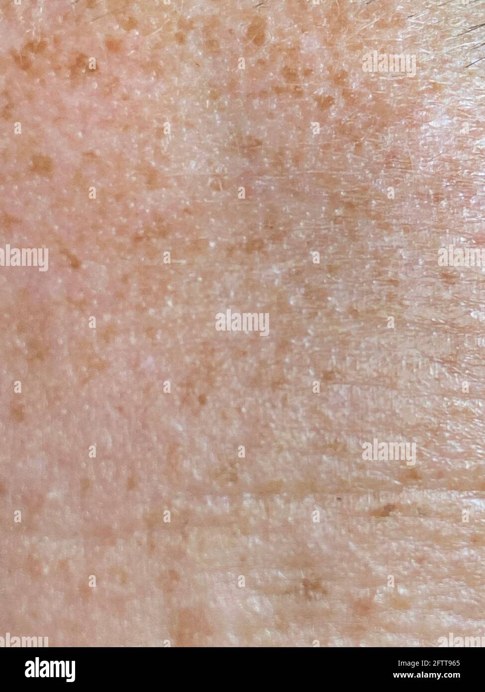 melasma lentigo on the skin of a man macro photo. Skin pigmentation ...