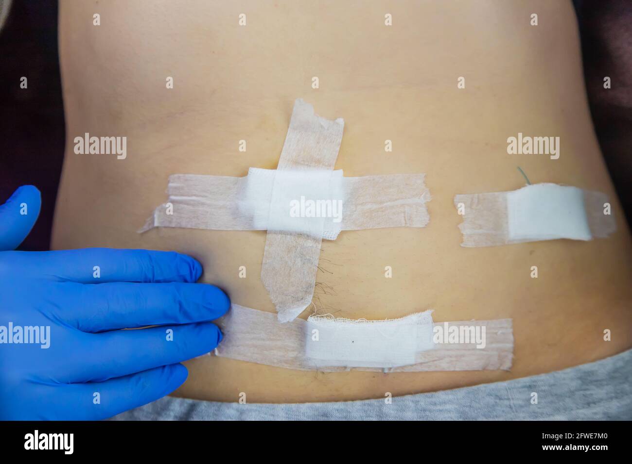 Appendix scar hi-res stock photography and images - Alamy